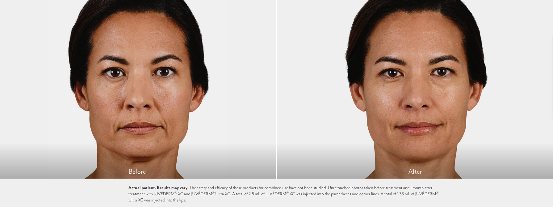 Juvederm - The Derma Face